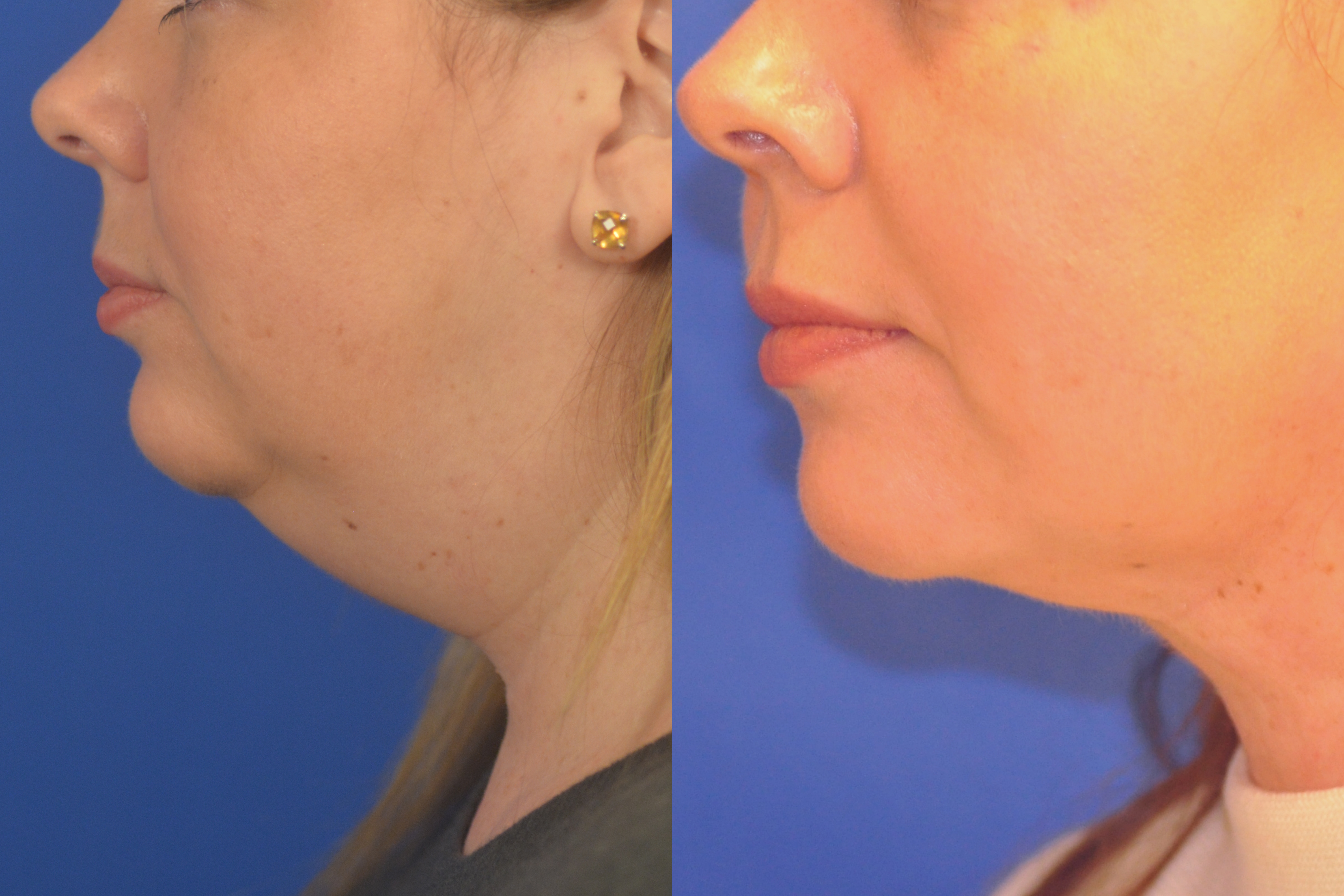 Smart liposuction of the chin S311 | Summit Health
