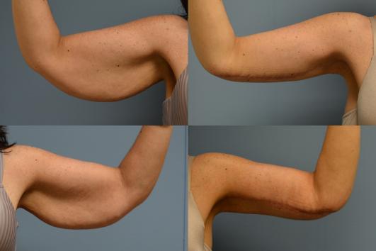 Arm Lift with Liposuction RmJ2022 | Summit Health