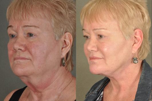 Blepharoplasty Lower Upper Face Lift Neck Lift Fat Grafting Chemical ...