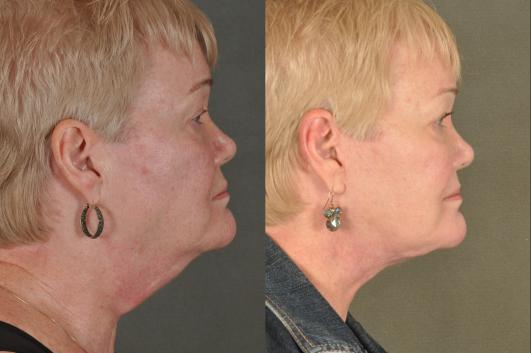 Blepharoplasty Lower Upper Face Lift Neck Lift Fat Grafting Chemical ...