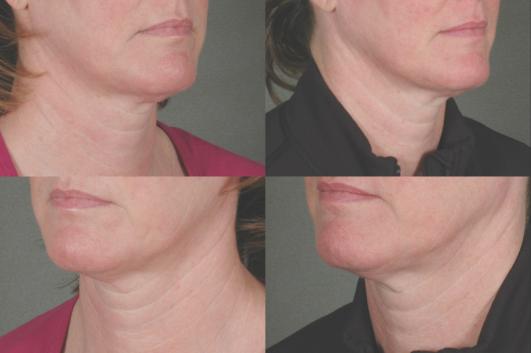 Ultherapy lower face and upper face | Summit Health