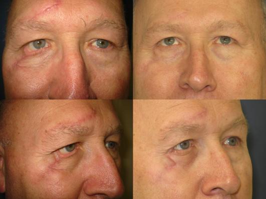 Laser vBeam Scar Revision B308 | Summit Health