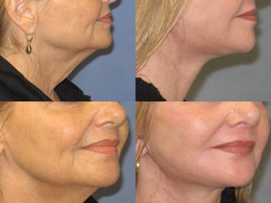 Blepharoplasty Lower Face Lift Neck Lift Dermabrasion B561-562 | Summit ...