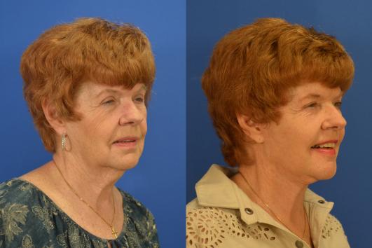 Face and neck lift S222 | Summit Health