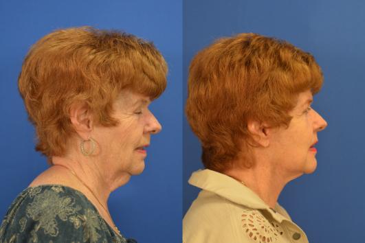 Face and neck lift S222 | Summit Health