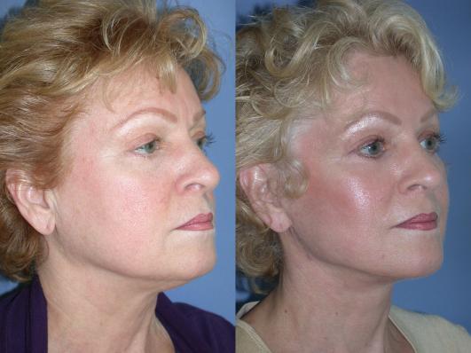 Face and Neck Lift with Eyelid Surgery P11 | Summit Health